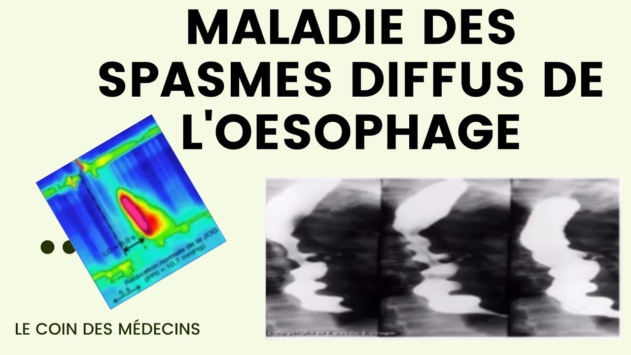 Maladie des spasmes diffus de l'oesophage - YouTube