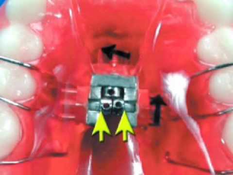 3 Way Expansion Screw Description - YouTube