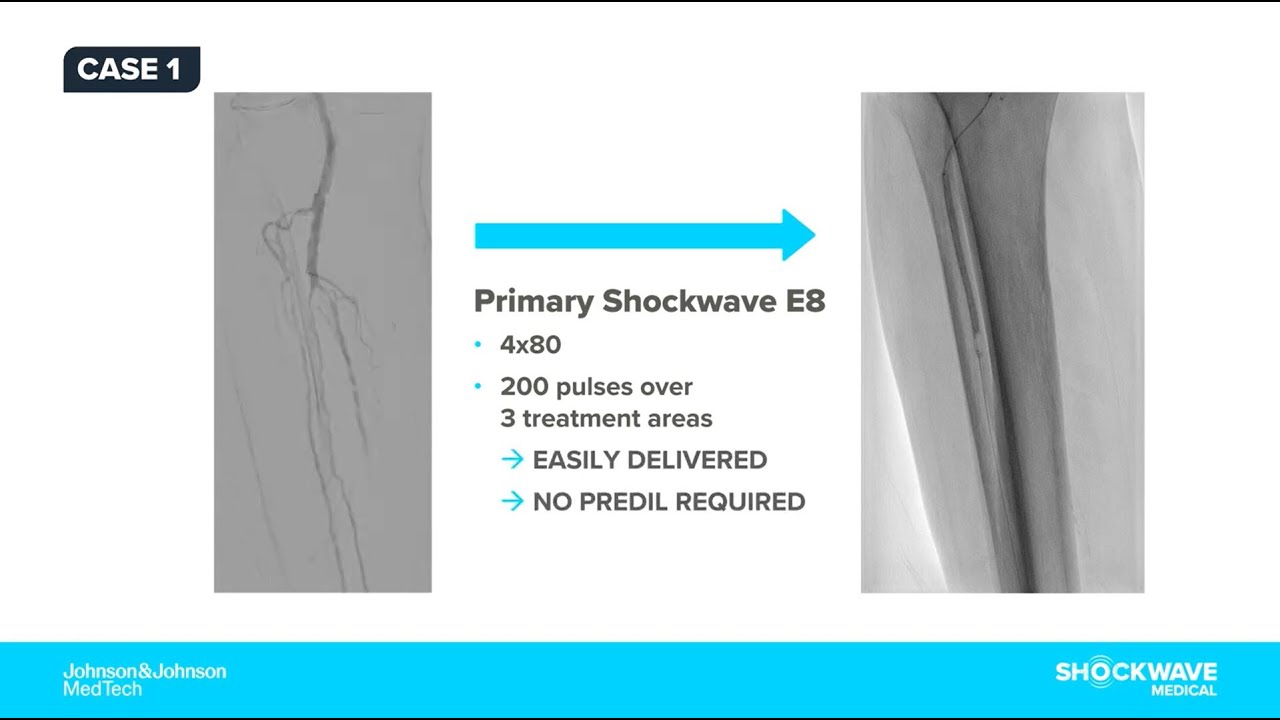Shockwave E8 Case Review with Dr. Michael Siah & Dr. Kyle Reynolds ...