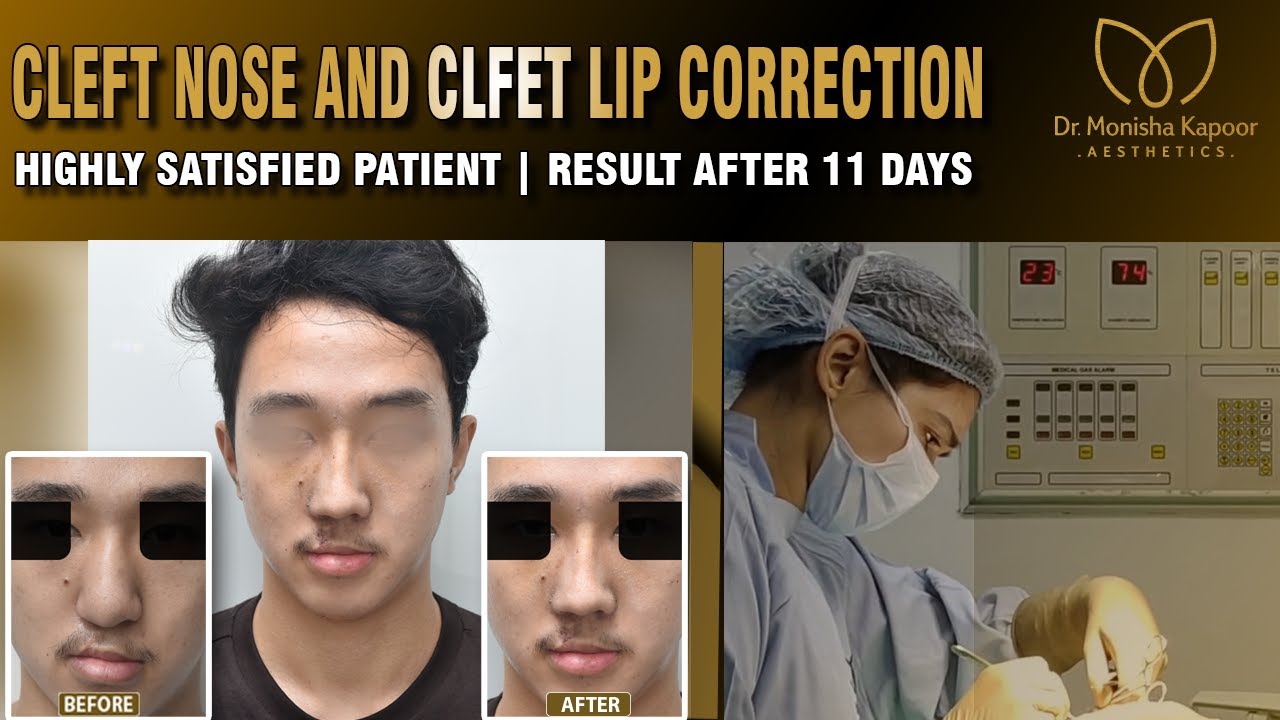 Life-Changing Cleft Nose & Lip Transformation |Dr. Monisha Kapoor's ...