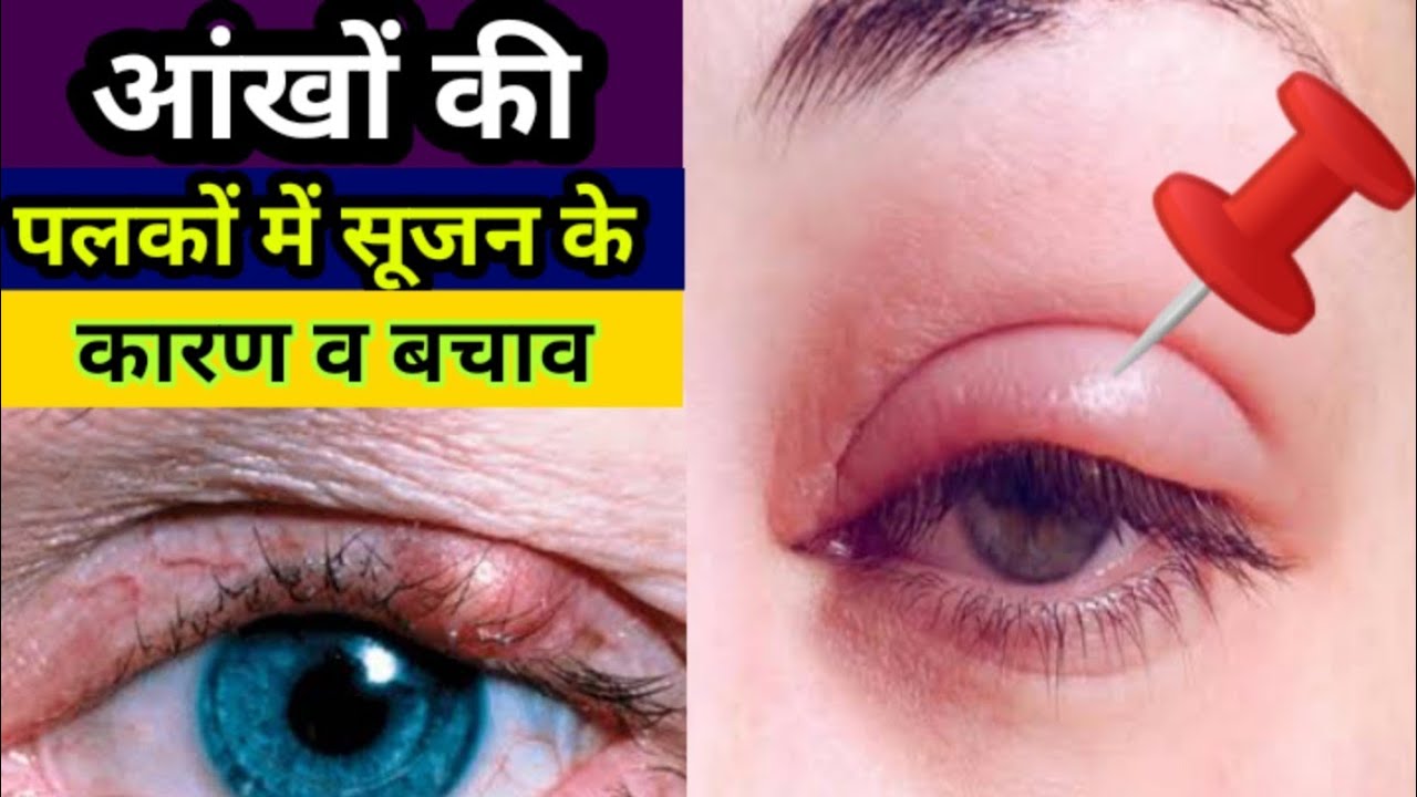 आंखों की पलकों में सूजन के कारण और बचाव | Aankhon ki palkon me sujan ...