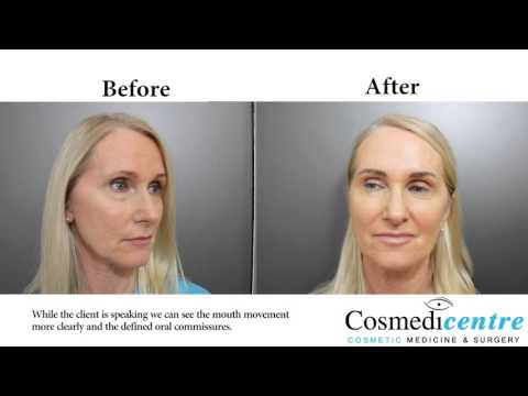 Oral Commissures Treatment Before and After by Cosmedicentre - YouTube
