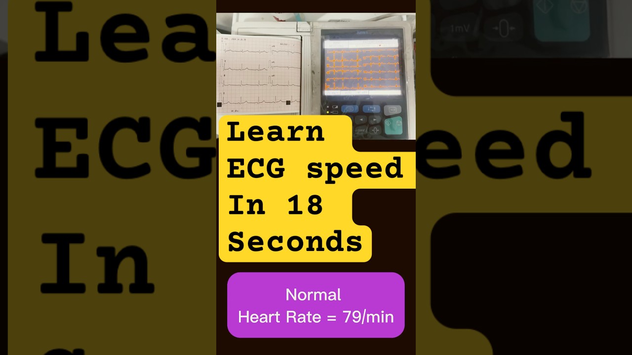 Read ECG in 18 seconds #ecg paper speed #heartrate on #ecg - Go IT