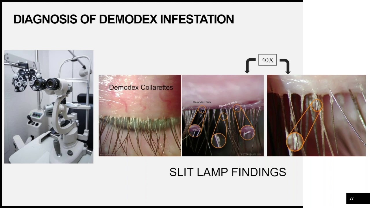 A Therapeutic Approach to Support Patients with Demodex + Therapies ...