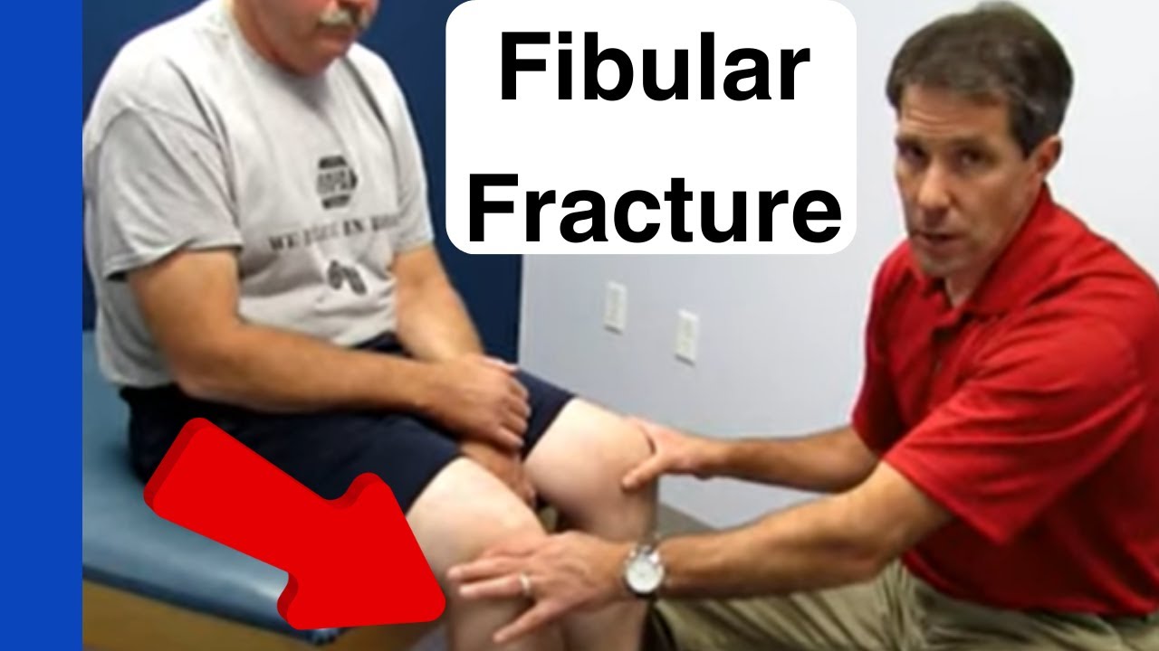 Proximal Fibular Fracture (clinical exam) - YouTube