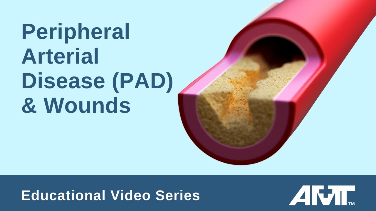 Peripheral Arterial Disease (PAD) & Wounds - YouTube
