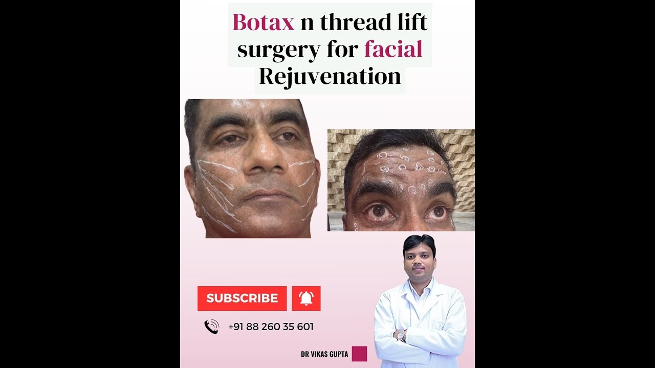 Facial Rejuvenation with Botax and Thread Lift Surgery in Jaipur | Dr ...