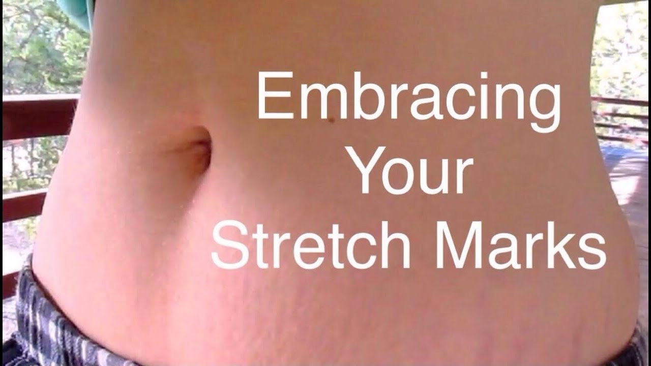 MOMS Embrace Your Stretch Marks - YouTube