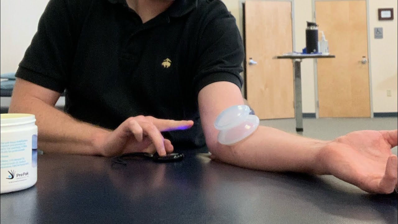 Cupping therapy for disc golf elbow pain - YouTube