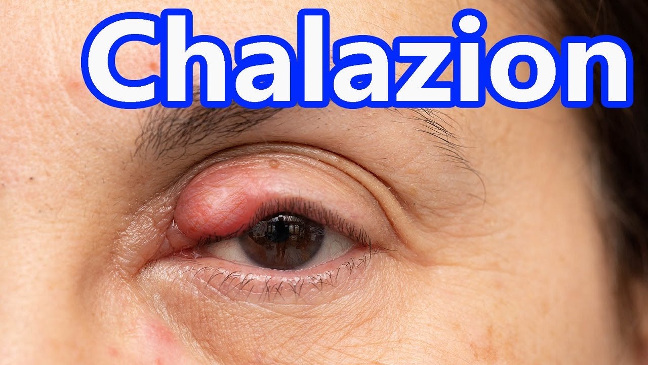 🔴 QUE ES EL CHALAZION | SINTOMAS ¿TIENE CURA? - YouTube