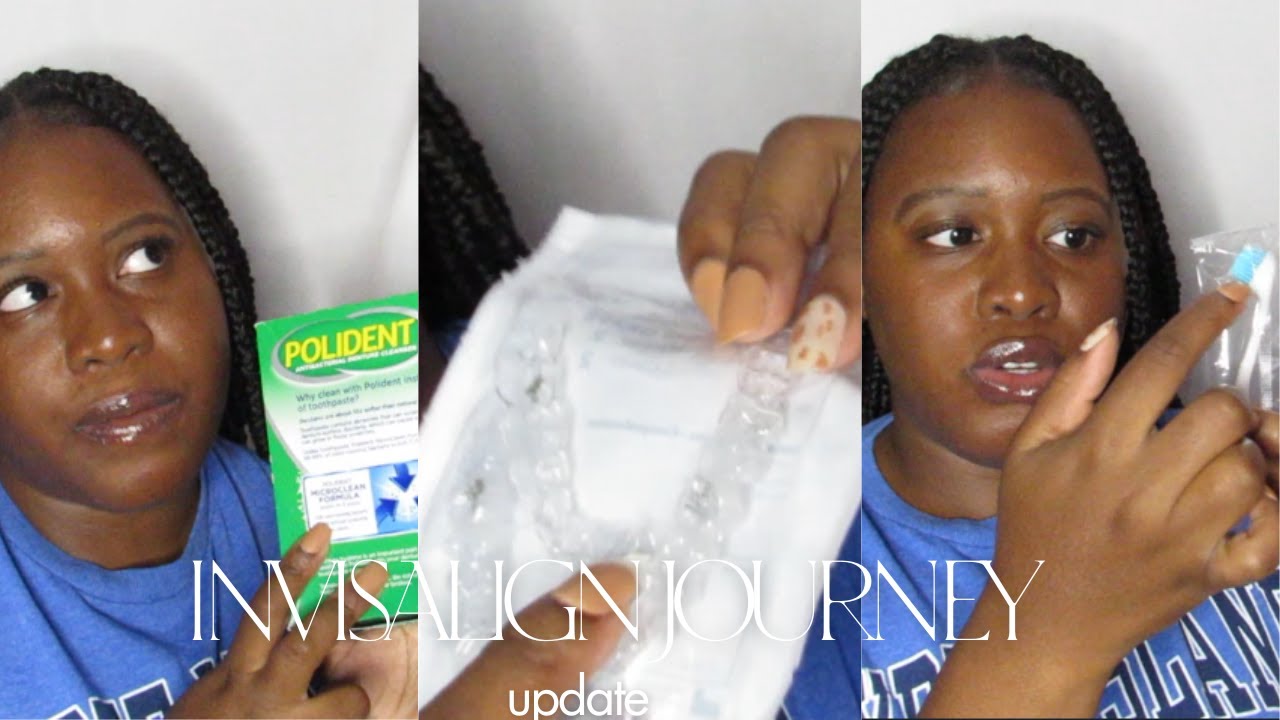 Invisalign Journey Update| Tooth Extraction, New Attachments, False ...