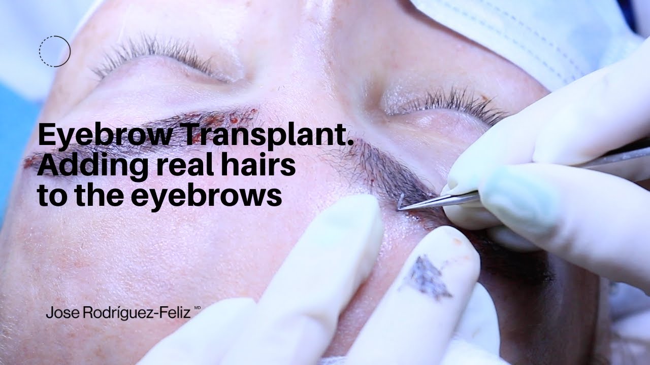 Eyebrow Transplant. Adding real hairs to the eyebrows - YouTube