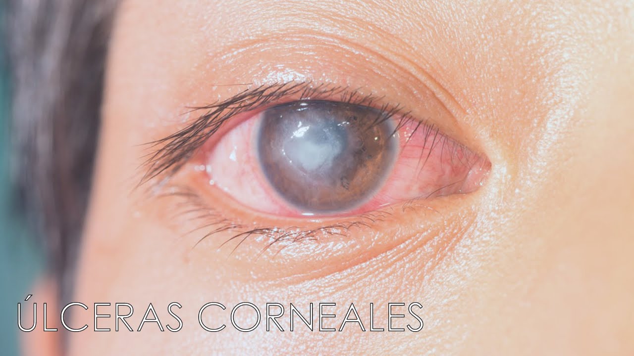 Todo Lo que Debes Saber sobre las Úlceras Corneales - YouTube