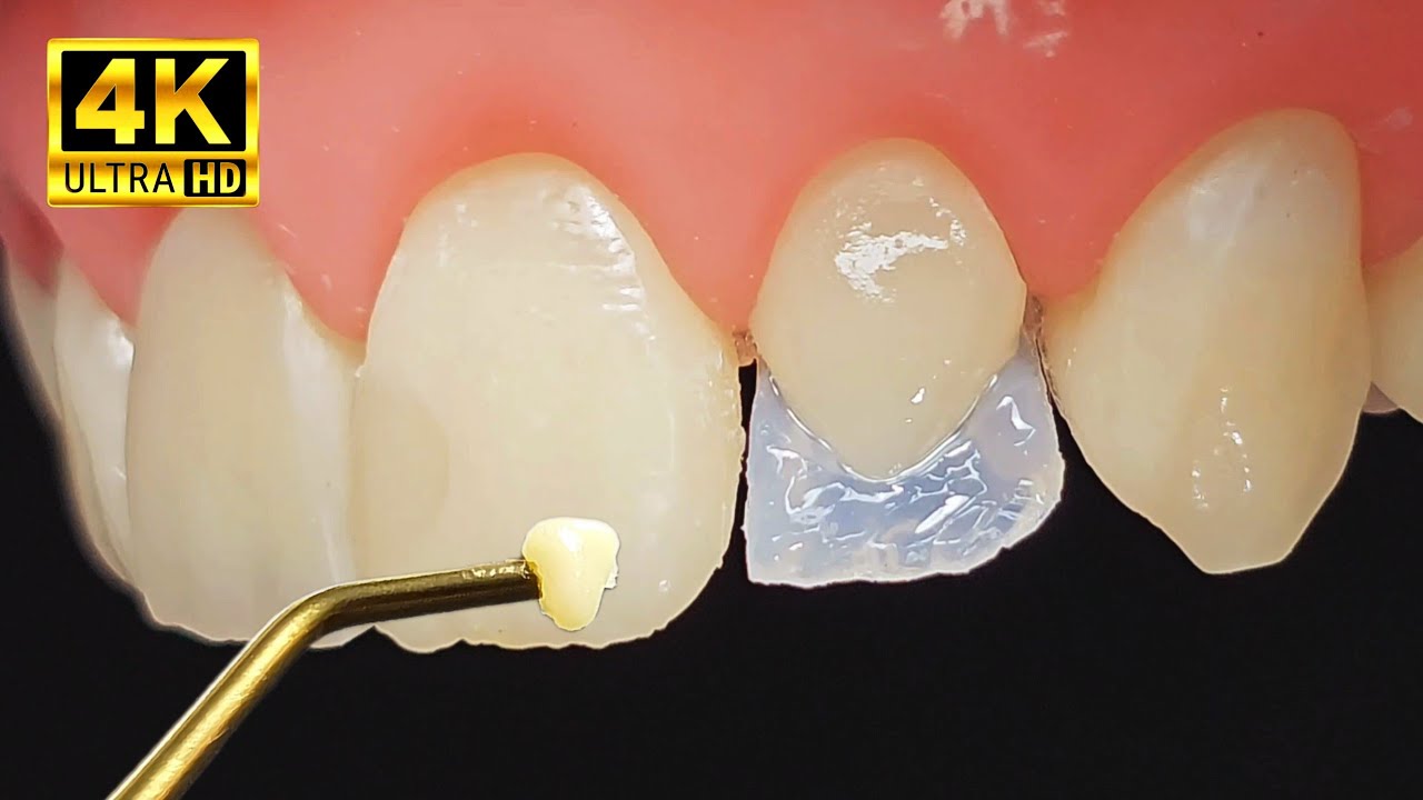 Incredible Peg Lateral Restoration | Satisfying Video - YouTube