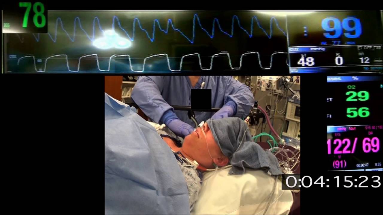 iWay demonstration #3 : 57% FiO2 at only 4 lpm O2 - YouTube