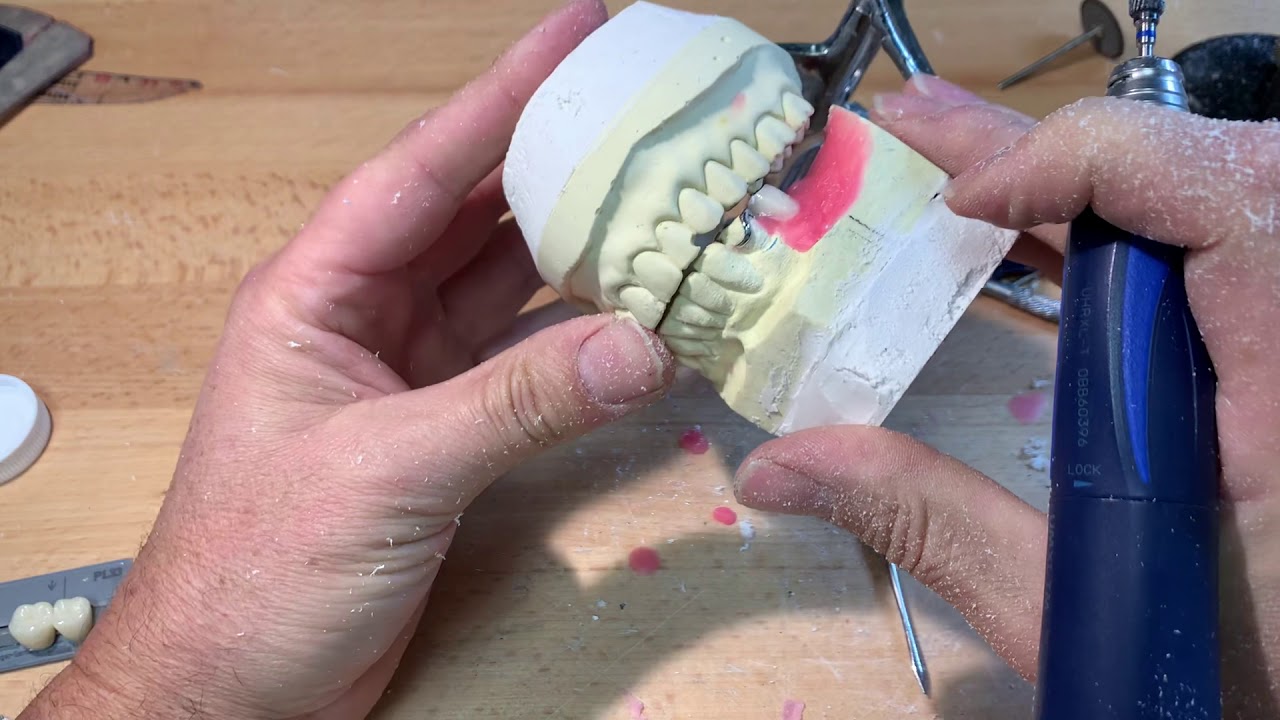 DENT 2004 Project#1 Set-up for try-in - YouTube