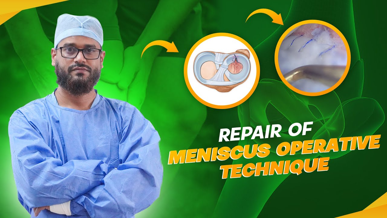 Meniscus repair operative technique ।। মেনিসকাস মেরামতের অপারেটিভ কৌশল ...