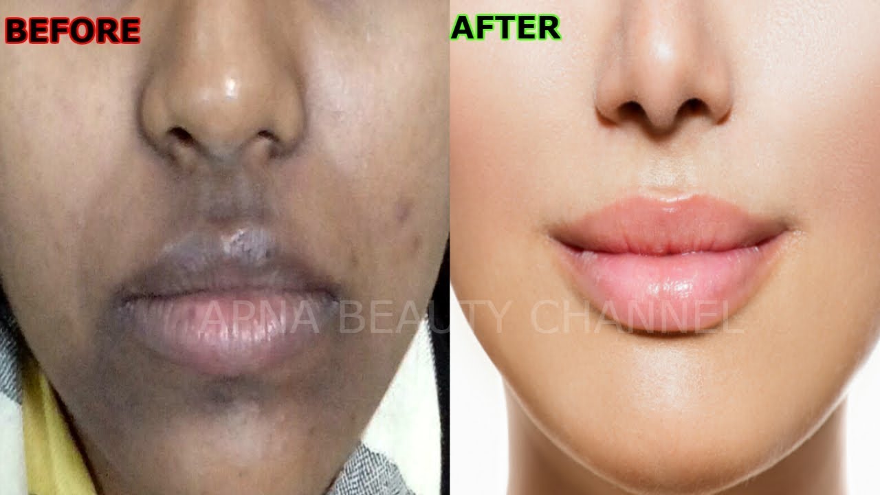 Hyperpigmentation Blackness Around Mouth Area Naturally hyperpigmentation-blackness-around-mouth-area-naturally