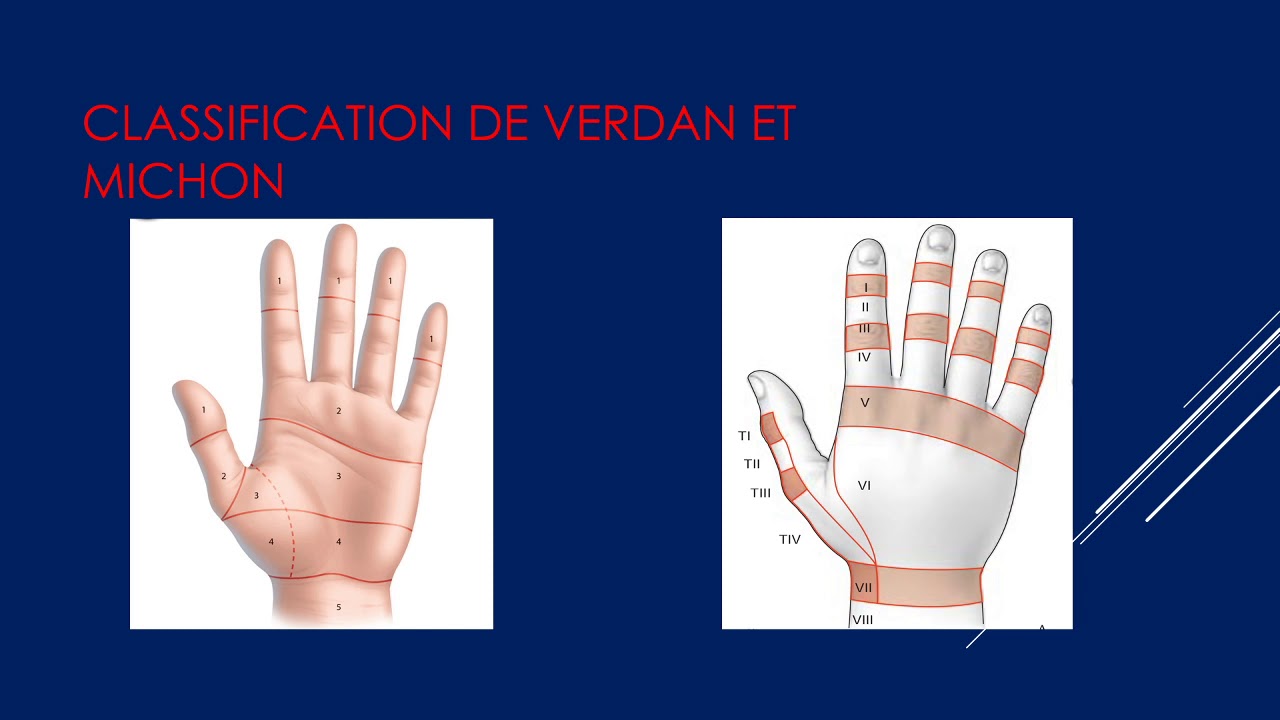 Les Plaies de la Main - Docteur Ould Mohammed - YouTube