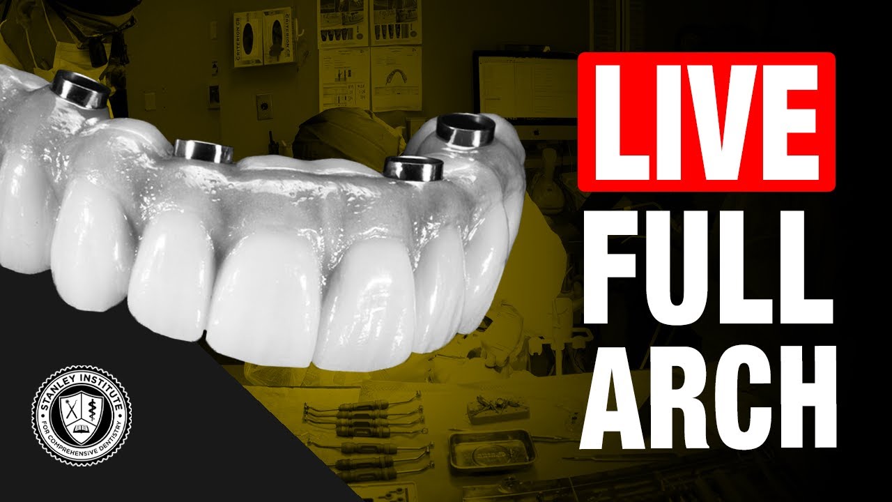 Full Arch Immediate Implant Reconstruction - YouTube