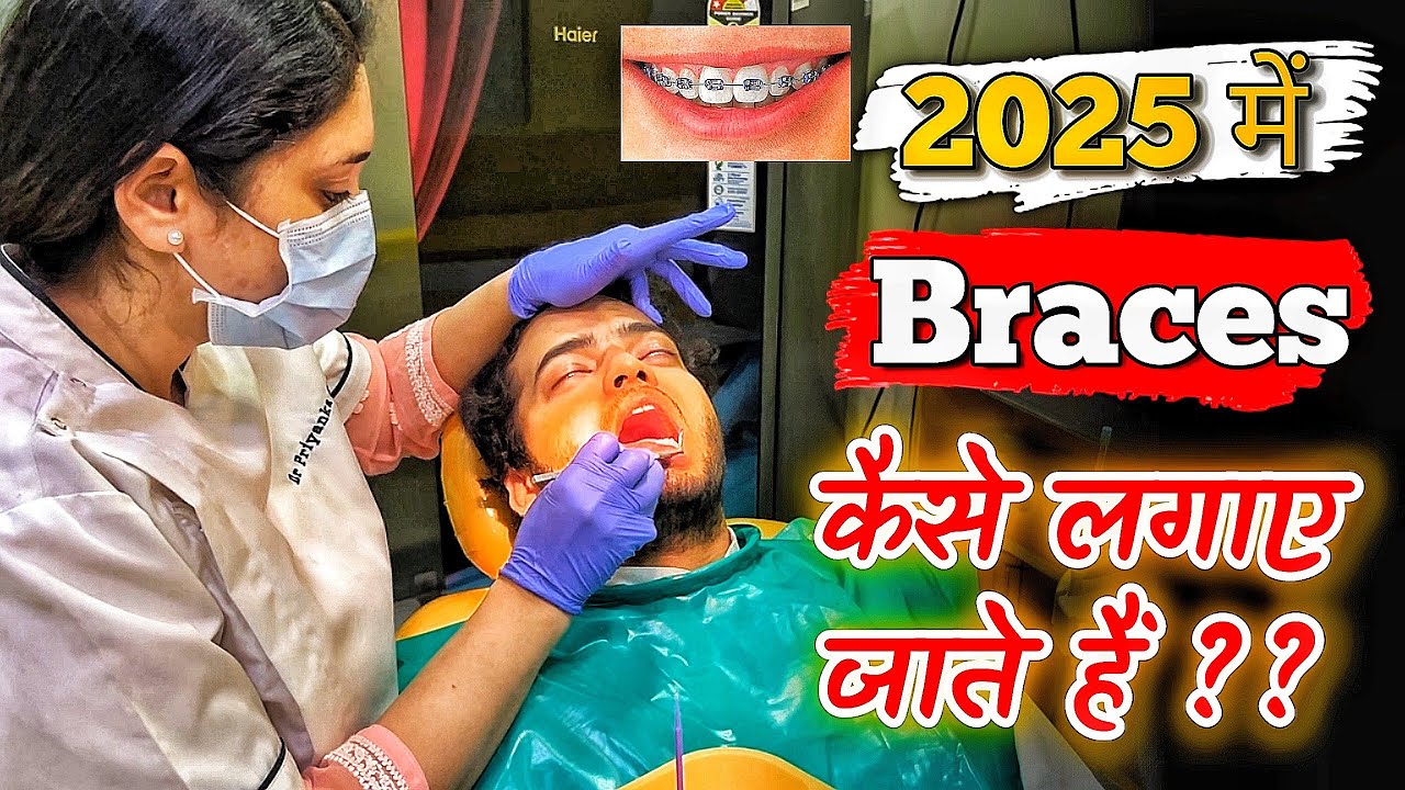 Braces कैसे लगाए जाते हैं | Braces Cost in India 2025 | #bracesupdate #braces #bracescost - YouTube