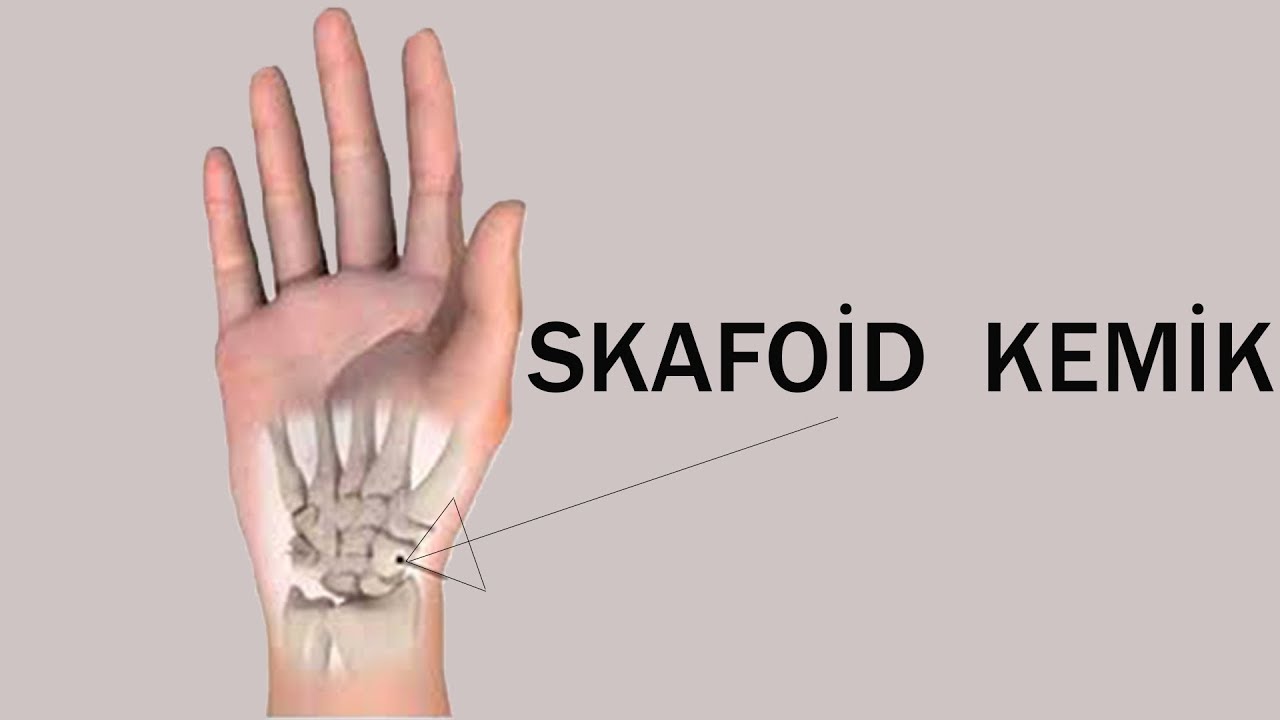 Skafoid Kemik Kırıkları - YouTube