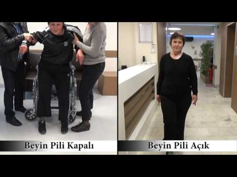 Ümriye Güler Beyin Pili Ameliyatı 5 yıl sonrası Pil Kapalı / Açık görüntüleri