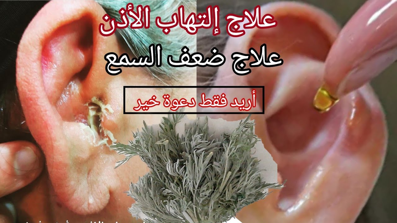 معجزة عشبة الشيبة في علاج إلتهاب الأذن بأسرع مما تتوقع نظف أذنك بهذه ...