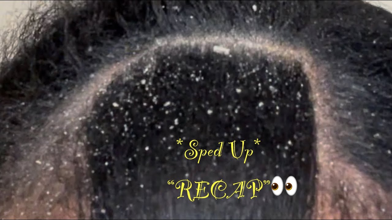 Dandruff Scratching Compilation 4K | Psoriasis Flakes Scalp Flareup ...