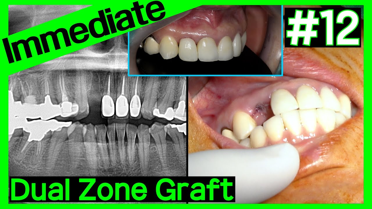 [Online Surgery] Immediate implant on #12 & dual zone graft - YouTube