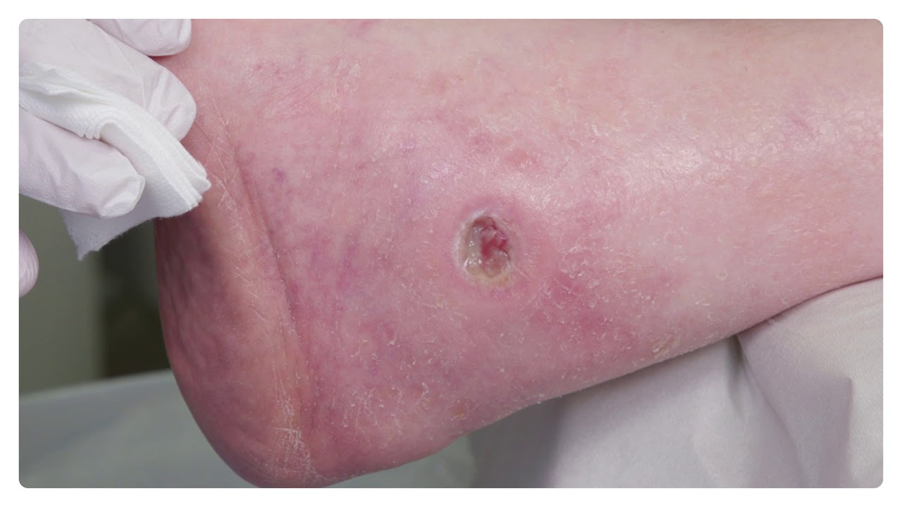 ChloraSolv Behandling - YouTube