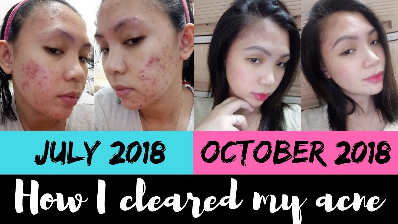 MY ACNE STORY | Skincare for Acne Prone Skin (Philippines) | AshOnTheGo ...