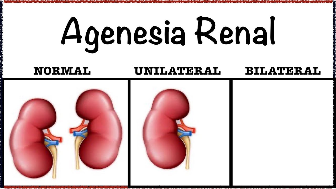 Agenesia Renal - YouTube