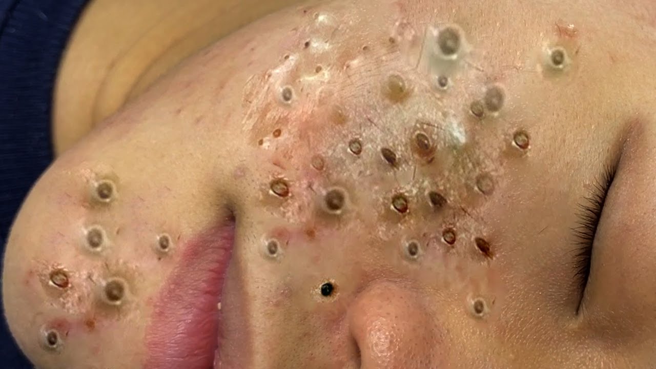 𝐌𝐨𝐬𝐭 𝐒𝐚𝐭𝐢𝐬𝐟𝐲𝐢𝐧𝐠 𝐏𝐢𝐦𝐩𝐥𝐞𝐬 𝐑𝐞𝐦𝐨𝐯𝐚𝐥 𝐀𝐭 𝐇𝐨𝐦𝐞 #1386 - YouTube