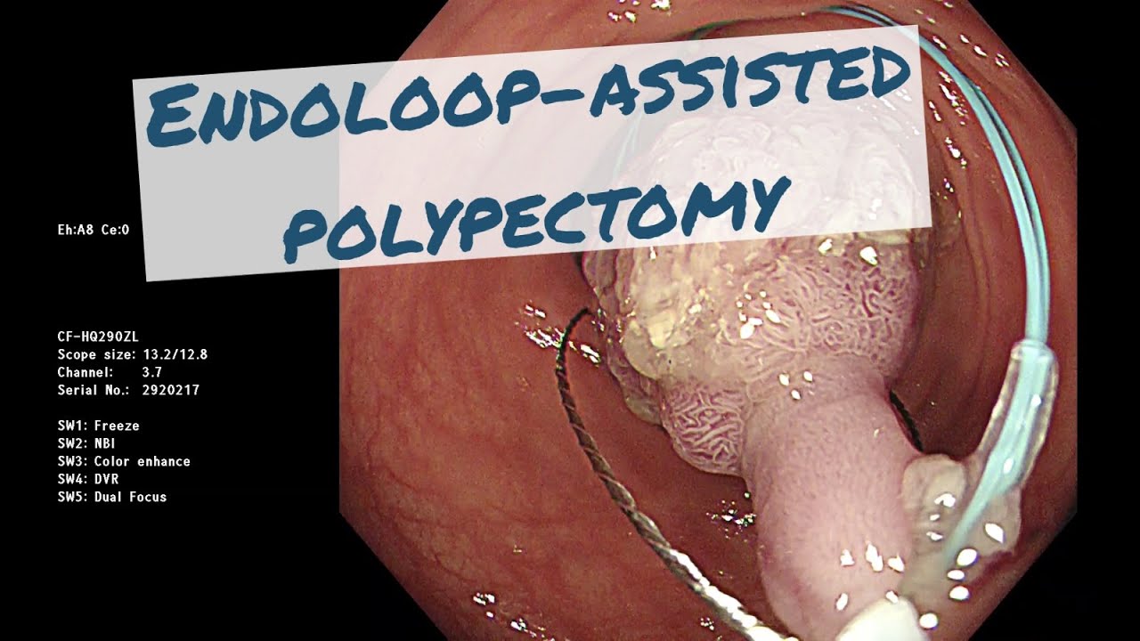 Endoloop-assisted polypectomy การตัดติ่งเนื้อลำไส้ใหญ่ - YouTube