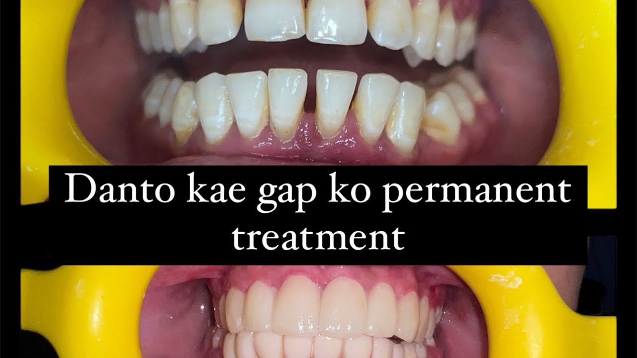 How to fix gap in the teeth permanently - YouTube