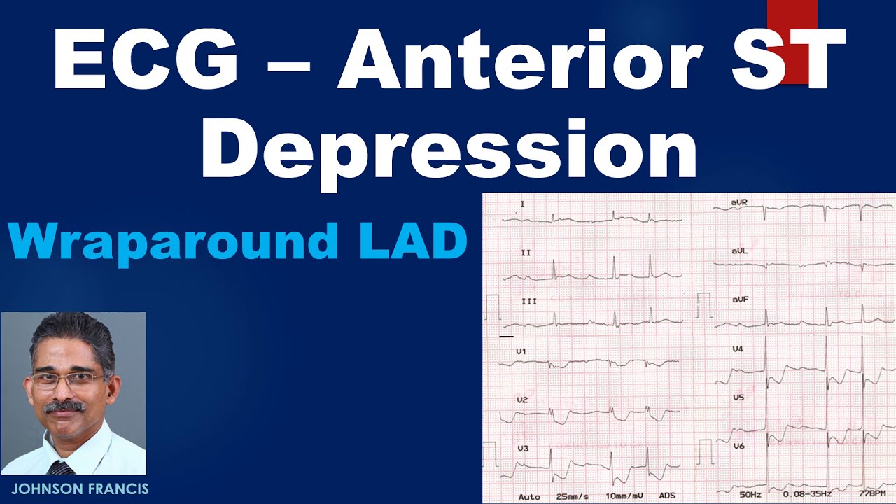 ECG – Anterior ST Depression (Includes a discussion on wraparound LAD ...