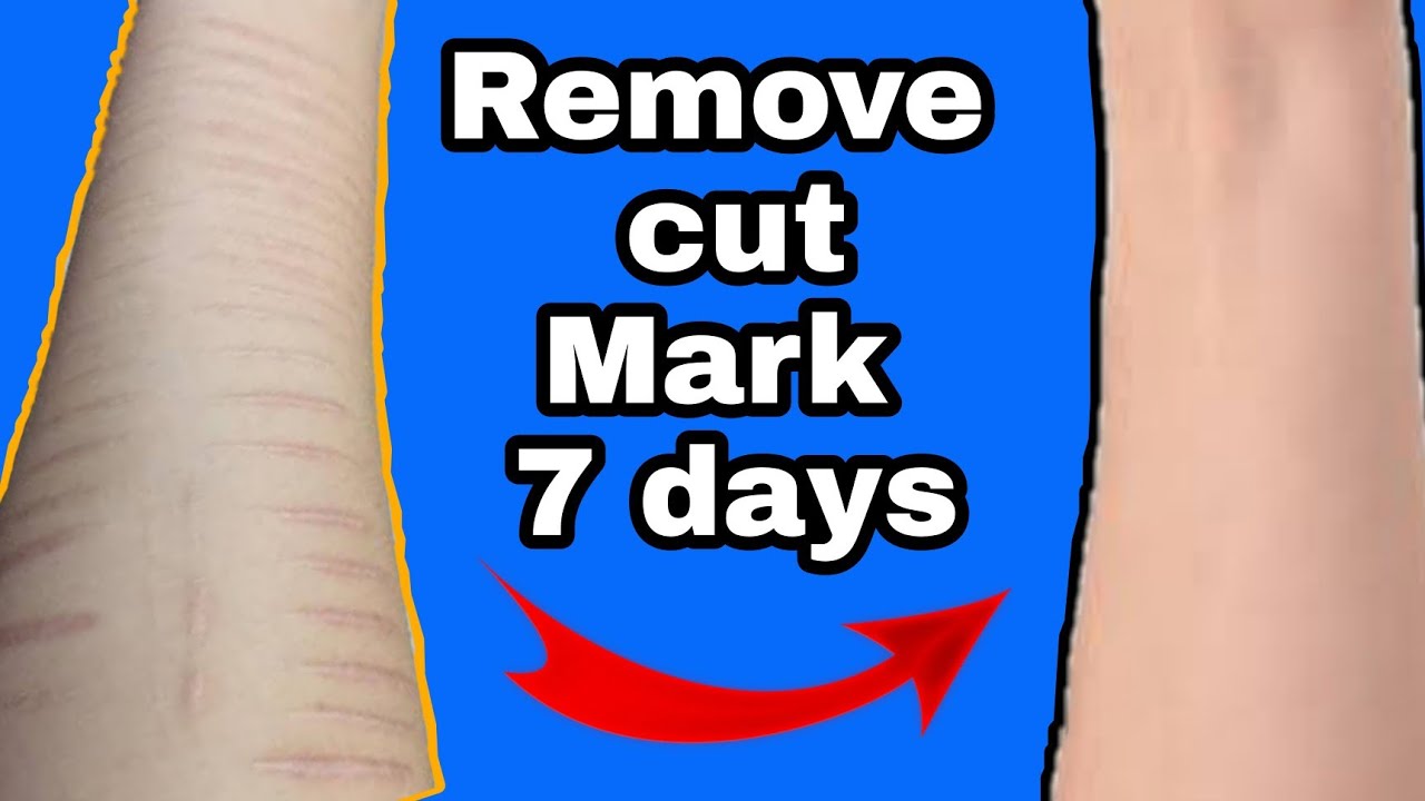 How To Remove Cut Marks Permanently How To Remove Scars how-to-remove-cut-marks-permanently-how-to-remove-scars