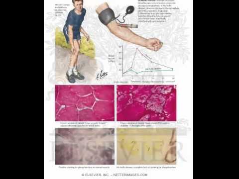 McArdle Disease (type V glycogen storage disease) - YouTube