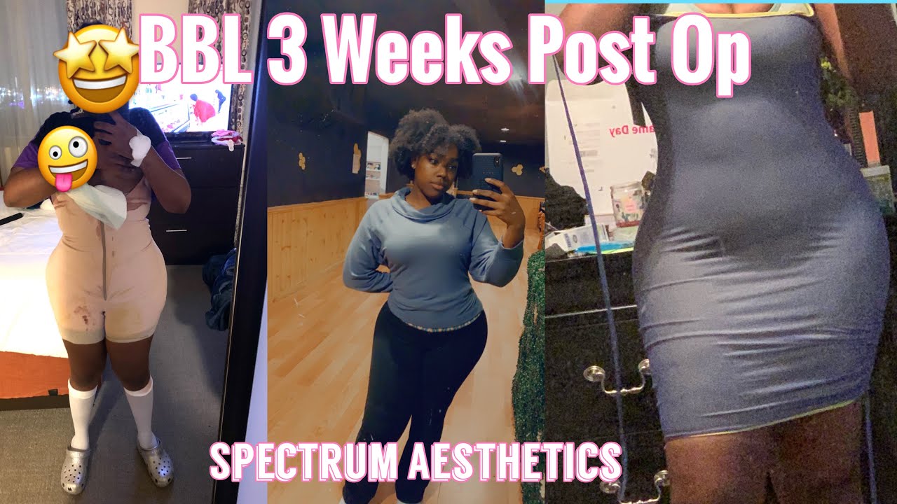 BBL 3/4 Weeks Post Op, Spectrum Aesthetics Dr. Timothy Bradley; BODY ...