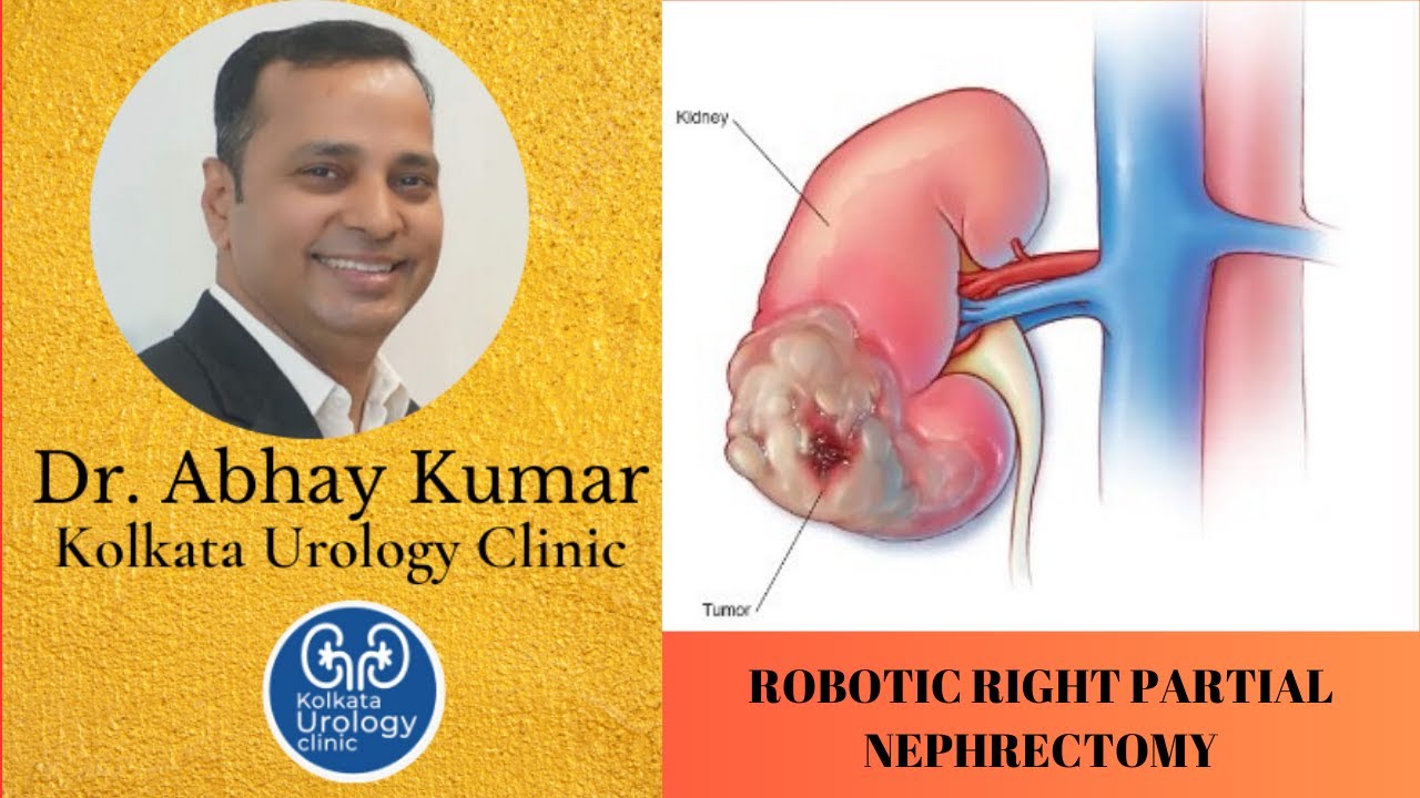 Robotic Right Partial Nephrectomy - YouTube