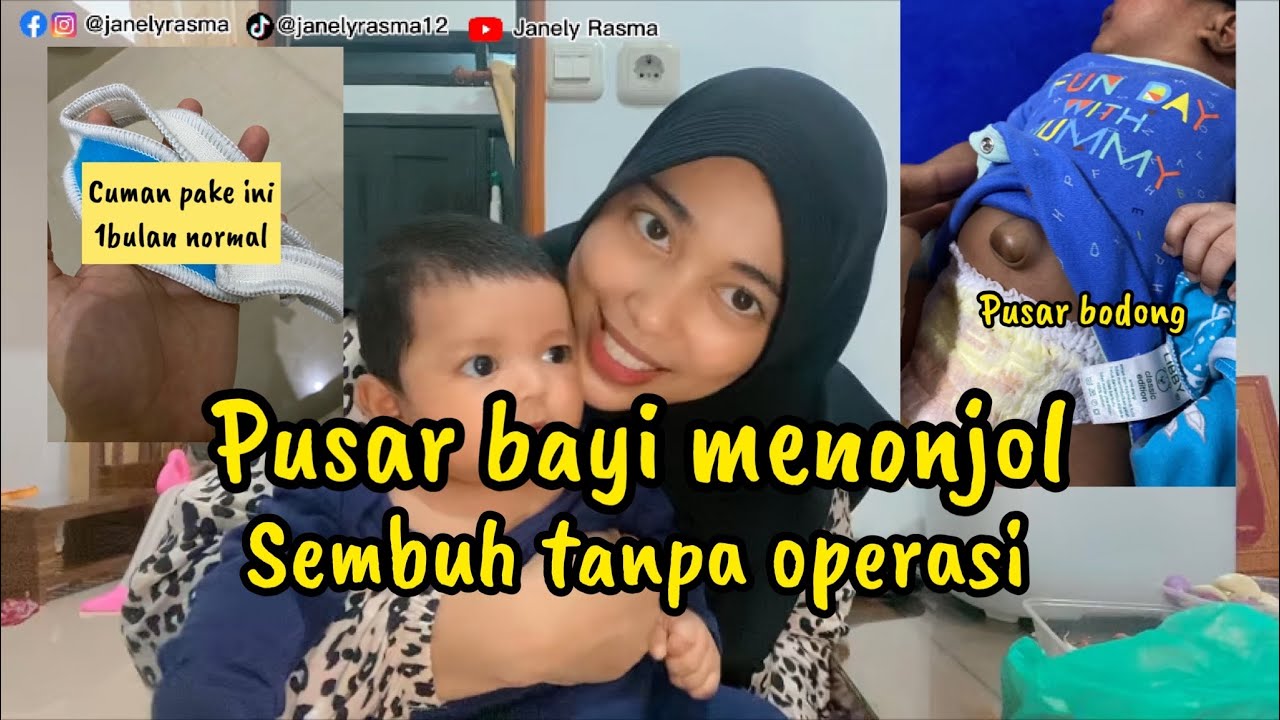 Cara mengatasi pusar menonjol / bodong pada bayi #bodong #pusatbodonh # ...