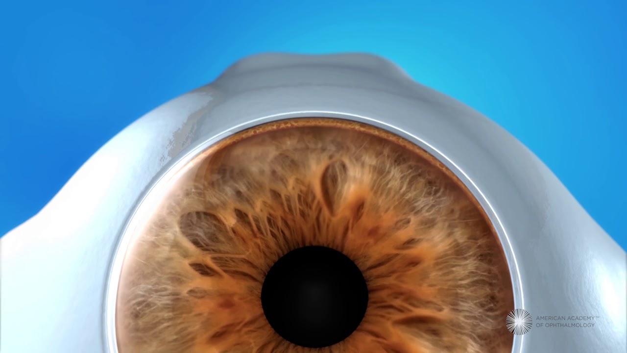 What is a trabecular bypass stent? - YouTube