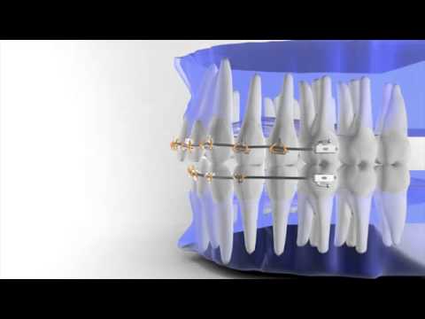 Fastbraces® Overbite animation - YouTube