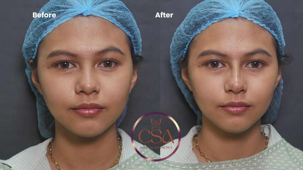 From short to long and narrow nose - YouTube