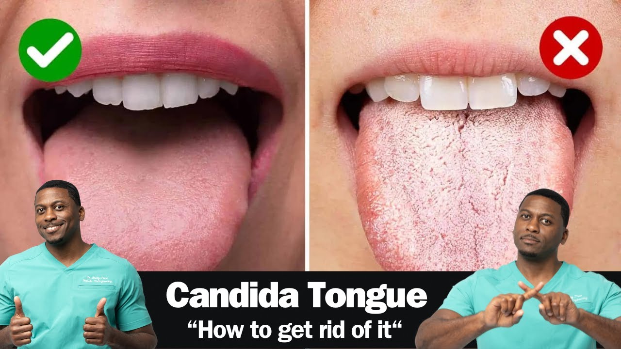 How To Fix A CANDIDA Yeast Overgrowth - Including Best Anti-fungal ...