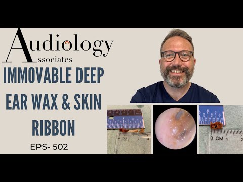 IMMOVABLE DEEP EAR WAX & SKIN RIBBON - EP502 - YouTube