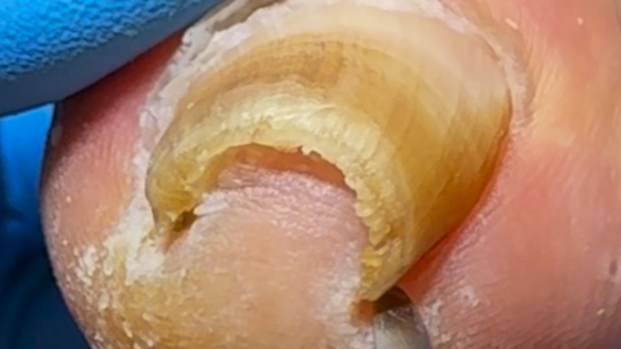 Amazingly Curled Toenails Completely Resolve The Patient's Condition ...