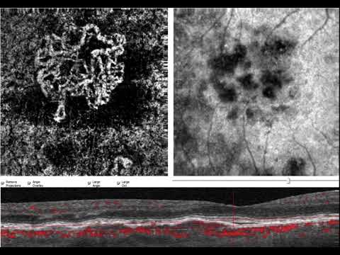 OCTA: Projection Artifacts Removal from Optovue PAR - YouTube