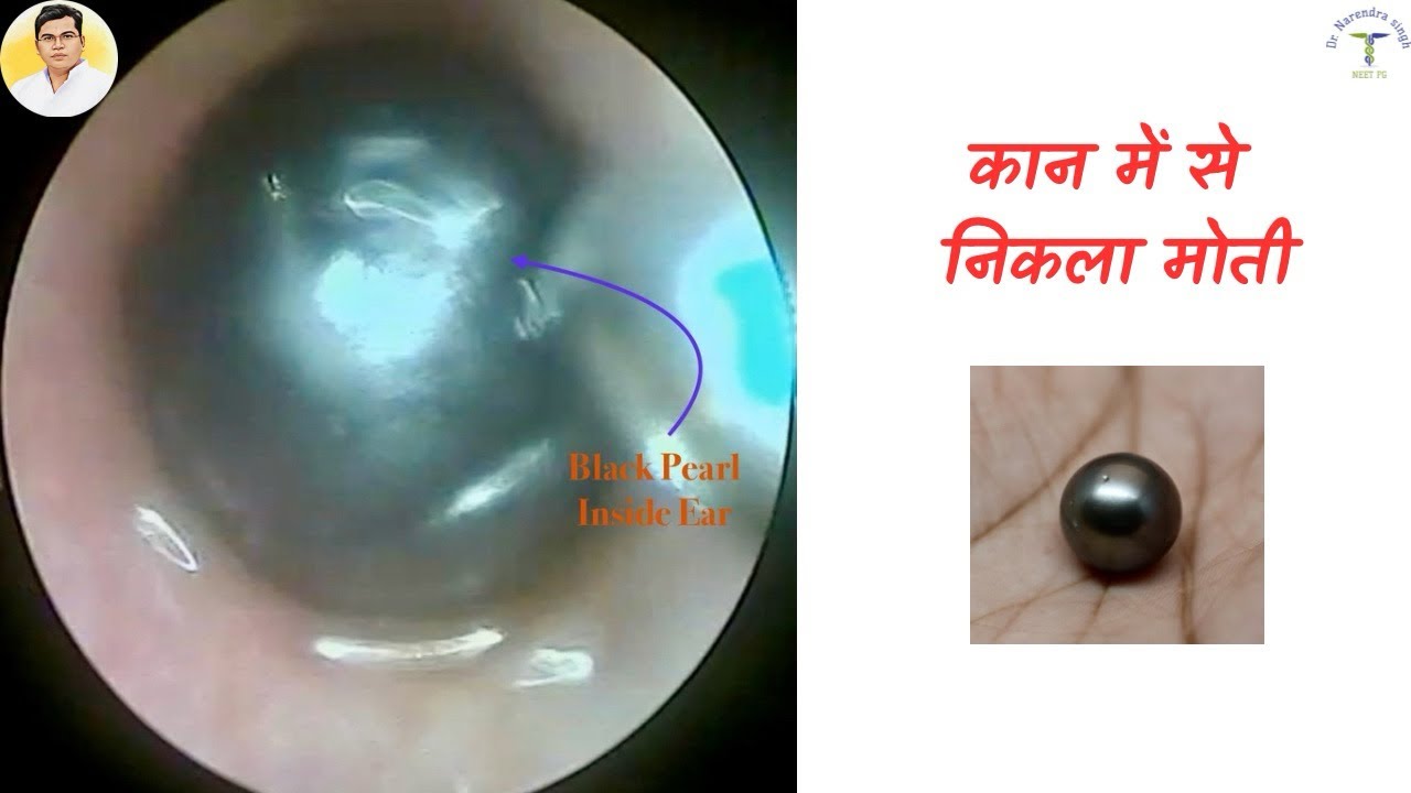 Black Pearl Inside Ear / कान में से निकला मोती / NEETPG 2024 - YouTube